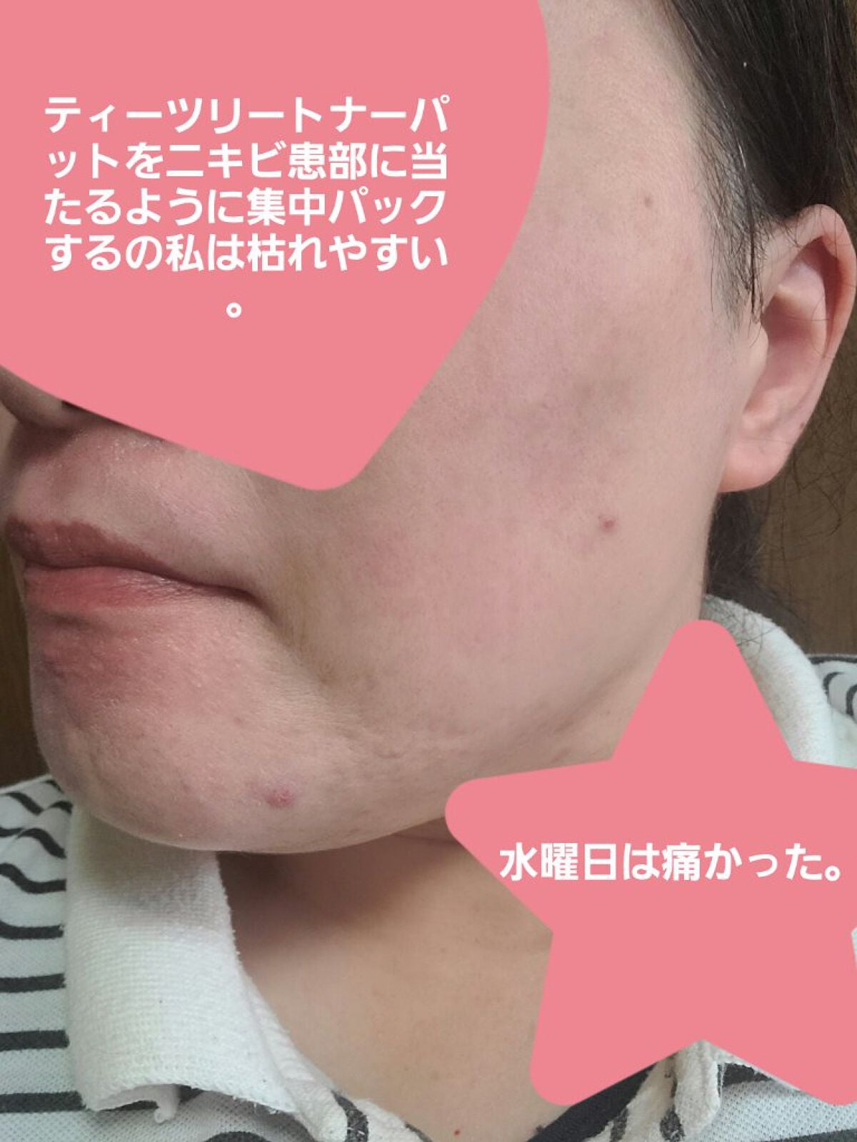 ティーツリーカーミングエッセンスパッド|medihealの口コミ 😄🙈顎まわりとか。。ニキビ大量生産活動顔面を救いたい By