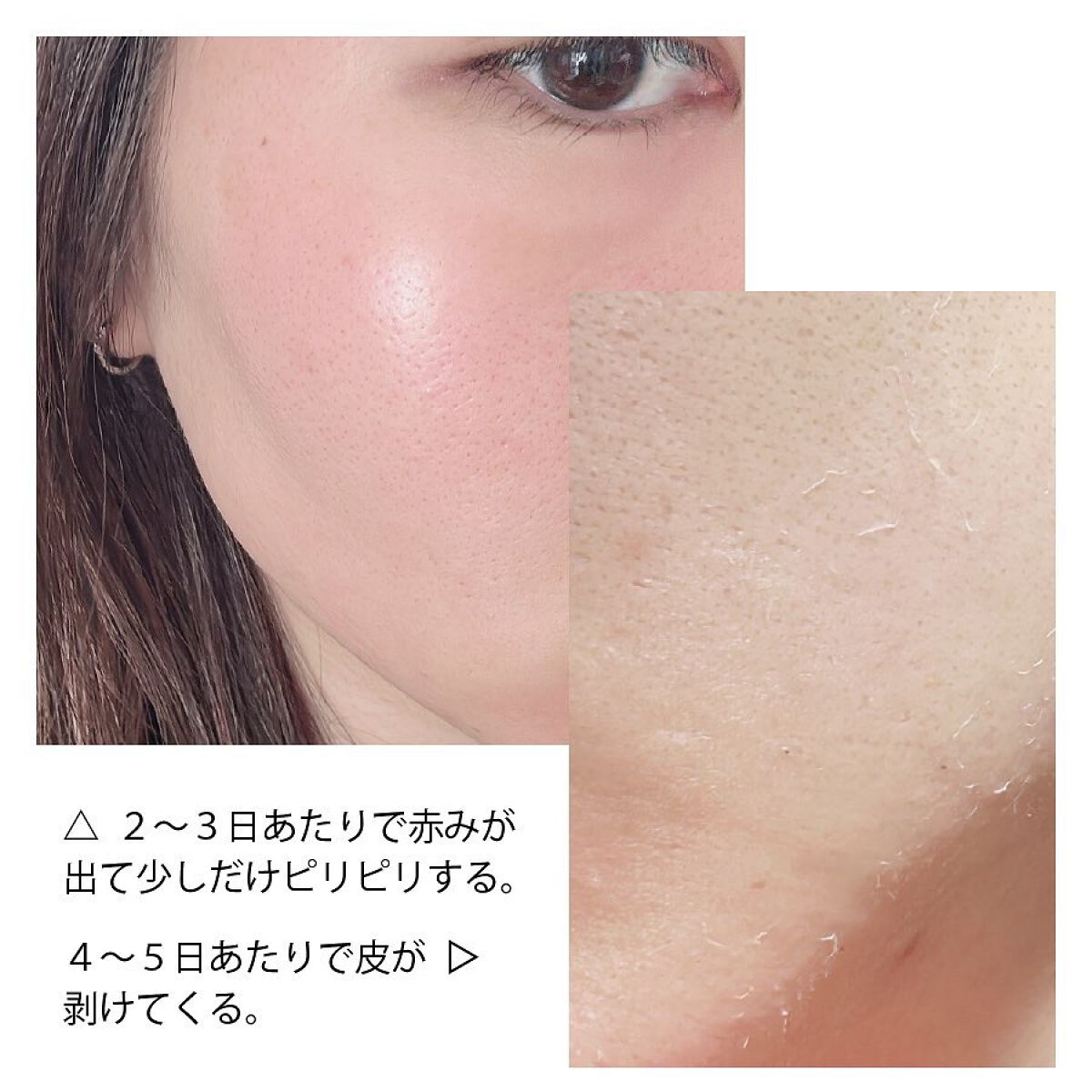 ダーマスキンピーリング|bqcellの使い方を徹底解説 ハーブピーリング お家で簡単にできる、塗って寝るだけのセルフピーリング! By