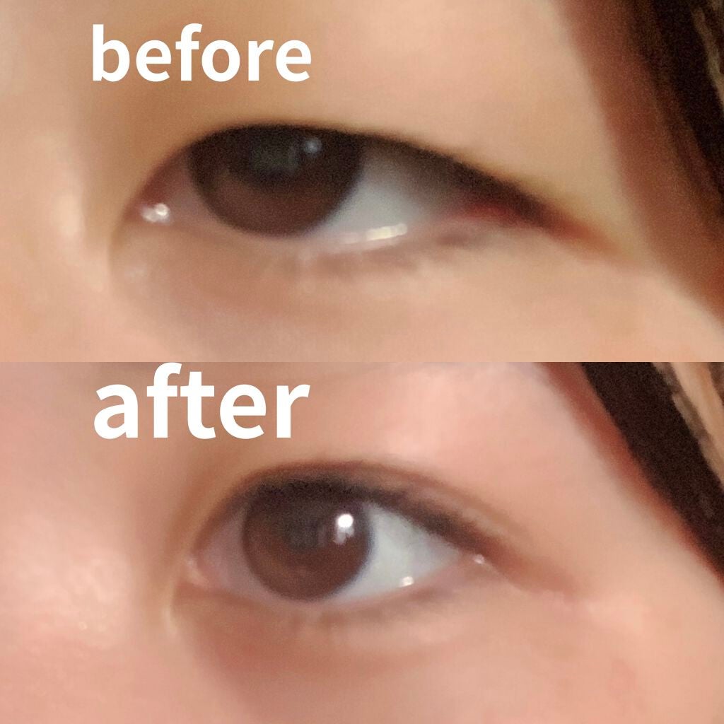 D Up・アイトークの二重まぶた用アイテムを使った口コミ 激重一重さん、一重さん、奥二重さん必見 By あめちゃん脂性肌20代前半