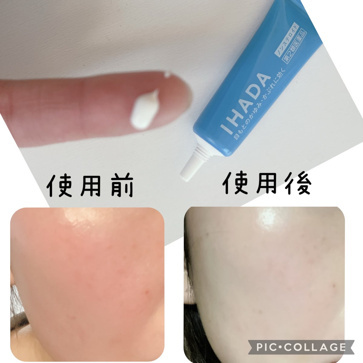 プリスクリードi医薬品|ihadaの口コミ Ihada プリスクリードi By Misaki乾燥肌30代前半 Lips