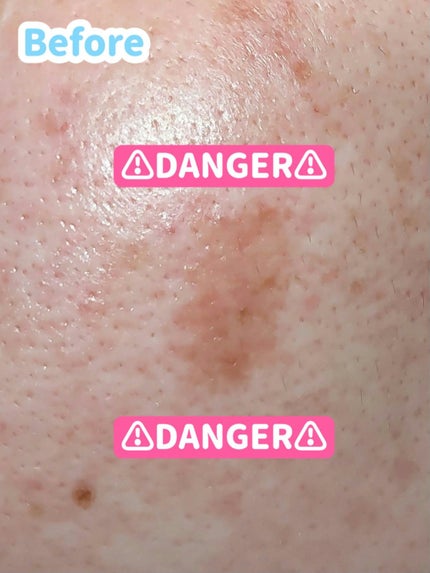 【試してみた】ホワイトcプレミアム医薬品 トランシーノのリアルな口コミ・レビュー Lips