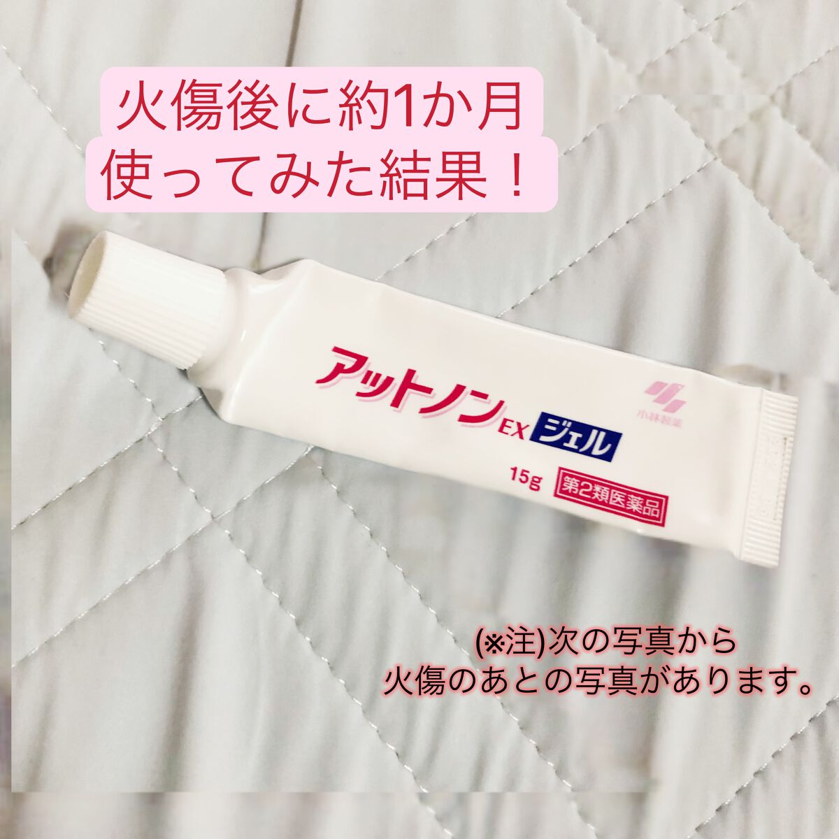 アットノンex ジェル医薬品|アットノンの効果に関する口コミ *注意2枚目から火傷あとの写真があります。 By 美奈敏感肌