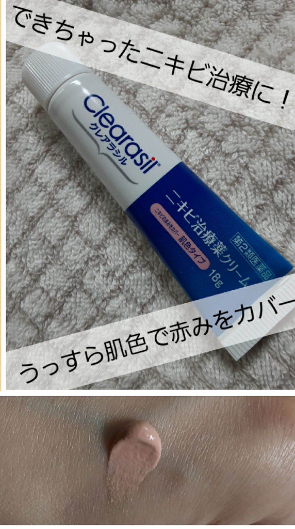 ニキビ治療薬クリーム 医薬品|クレアラシルの辛口レビュー マスク生活でニキビ大量発生!できちゃったニ By ちょこ🍫フォロバ100