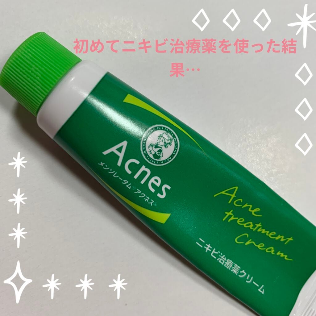 ニキビ治療薬医薬品|メンソレータム アクネスの口コミ 初めてニキビ治療クリームを使ってみた! By Hon 垢抜けたいお年頃混合肌