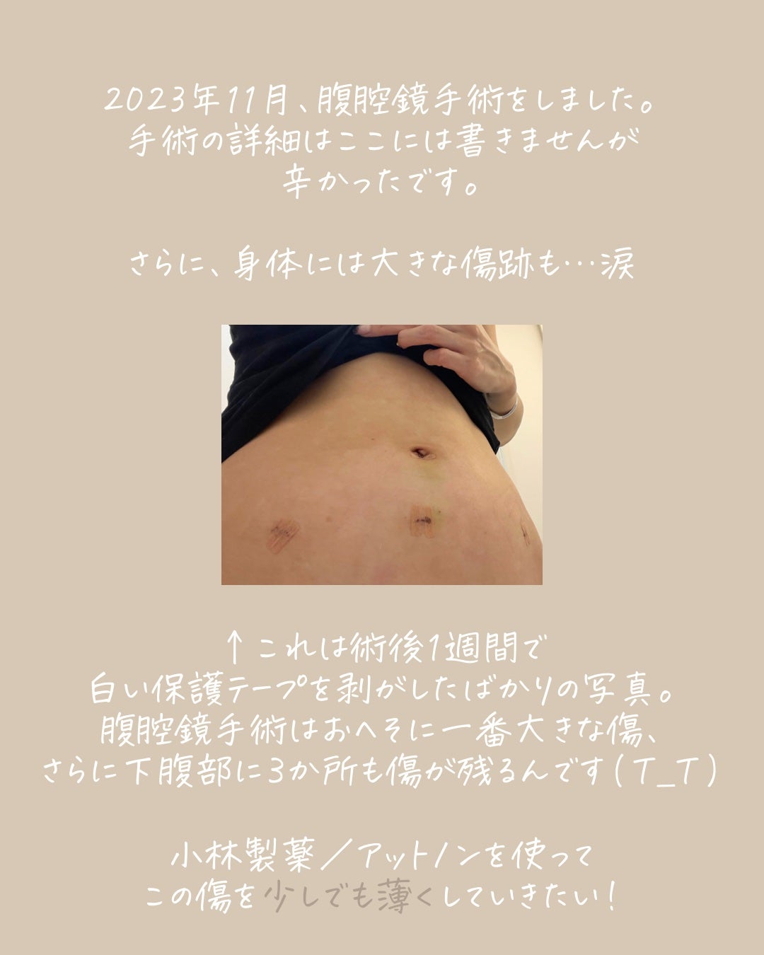 アットノンex クリーム医薬品|アットノンの口コミ 切腹傷の回復キロク 2023年11月、腹腔鏡手術をしました。 By さゆ🪄混合肌