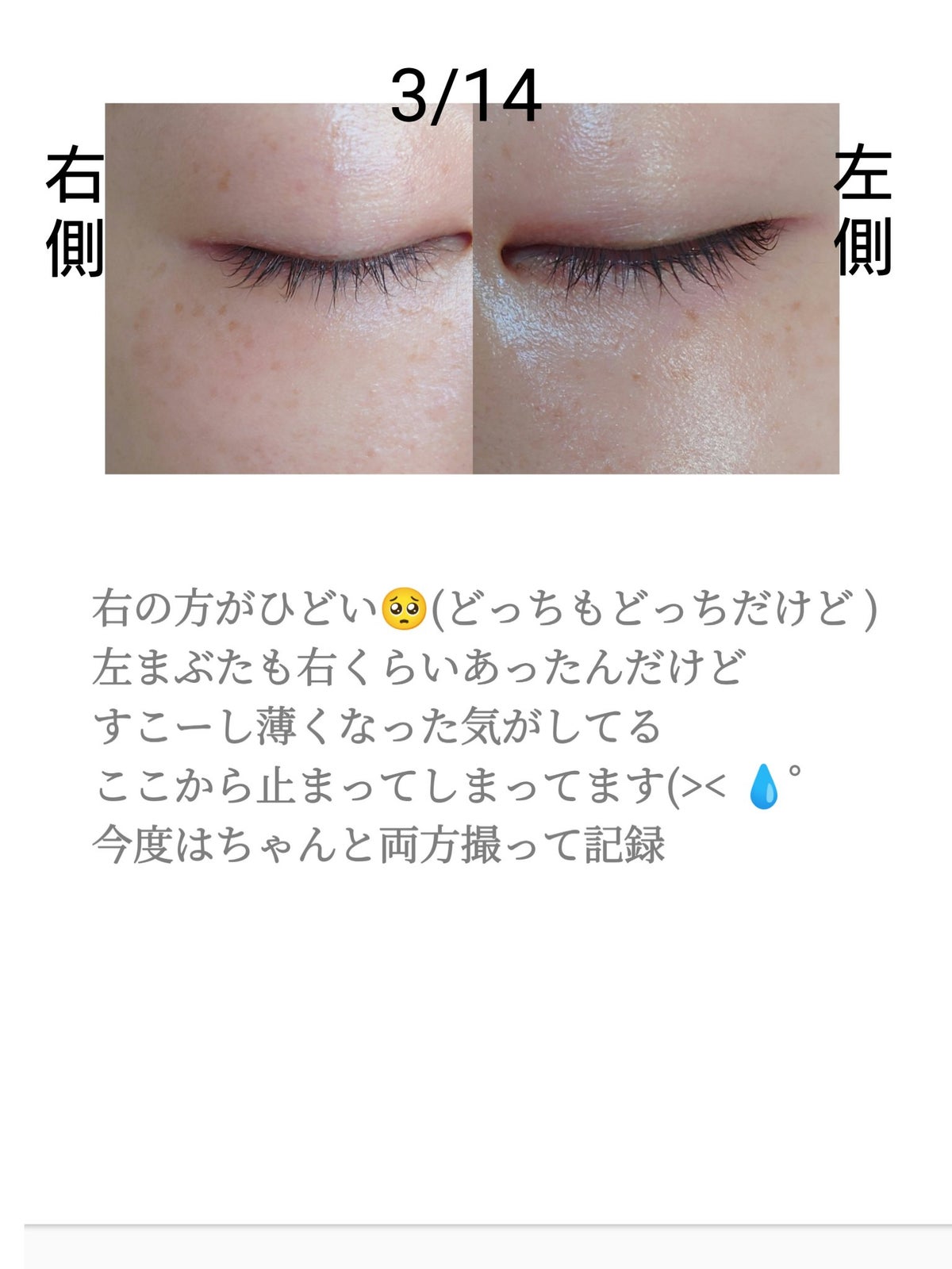 ホワイトcクリア医薬品|トランシーノの効果に関する口コミ 一番わたしの中では、これが効果感じたあと、変化がとまったので色々試してみた