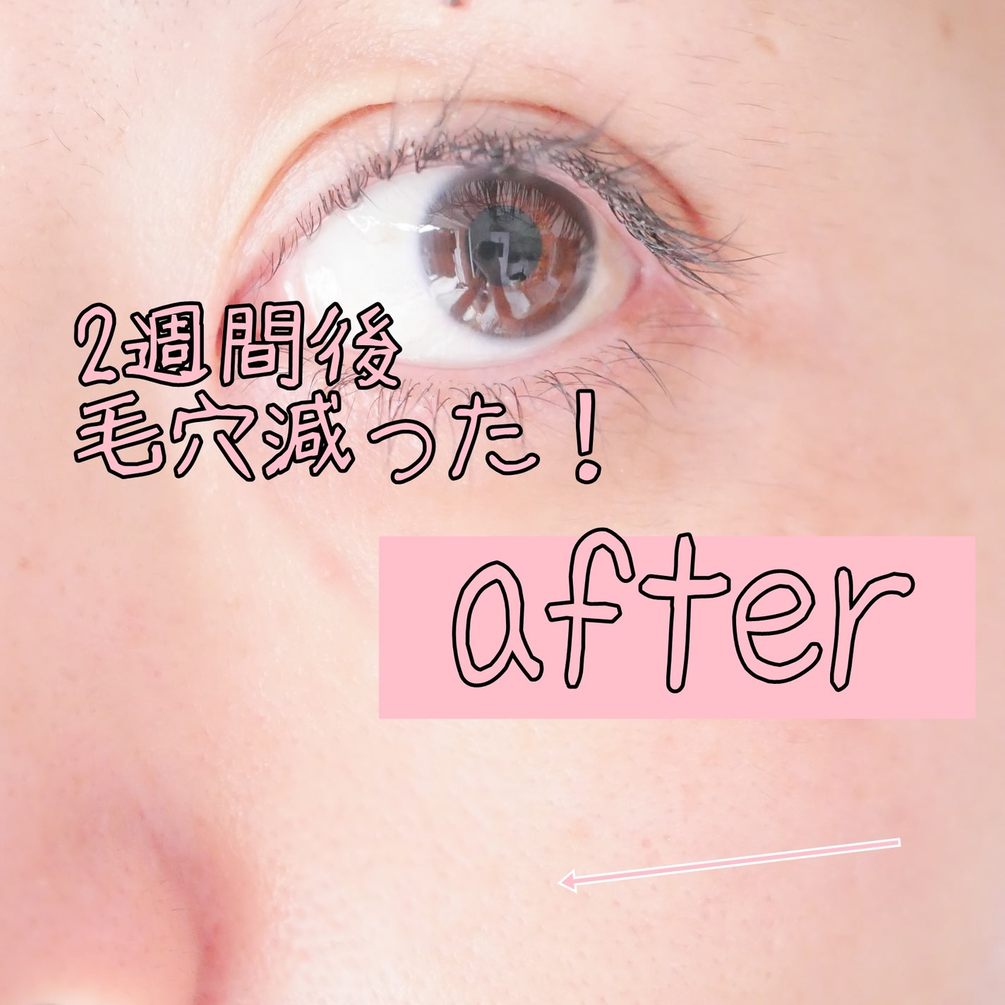 毛穴アンプル|ブランの効果に関する口コミ 2週間毛穴消しゴムアンプル! By 札幌インフルエンサー リリ Lips