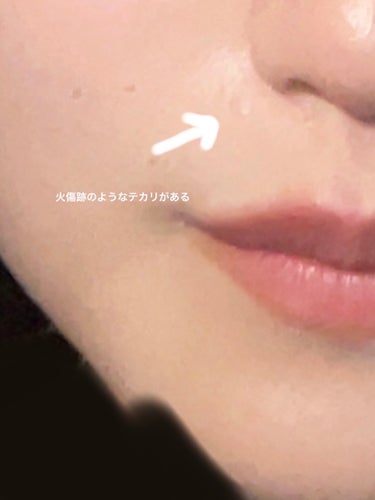 【試してみた】キズを早くきれいに治すパッチ Matsukiyoのリアルな口コミ・レビュー Lips