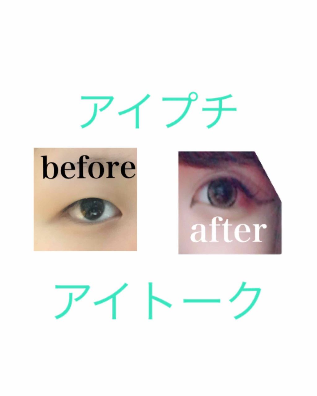 D Up・アイトークの二重まぶた用アイテムを使った口コミ ぼったり一重の私ですが、アイテープとアイプチで理想的な二重に😳💗 By きこ