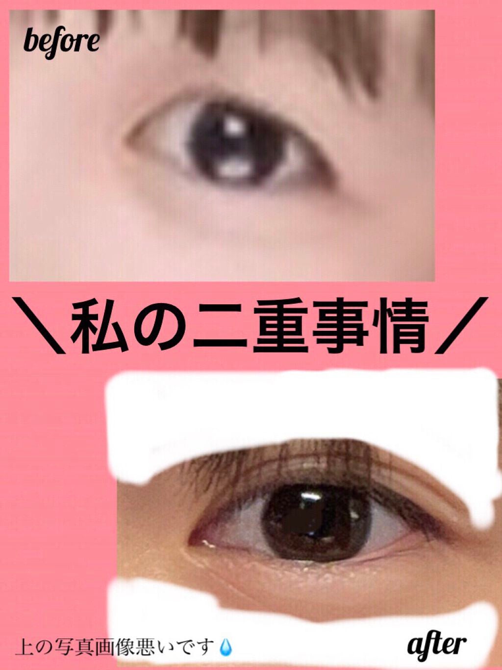 《二重になる方法》夜用ふたえメイク|プレビュートの使い方や二重メイク お久しぶりですっ!ぽーです🍒 By ぽーです🍒 フォロバ100敏感肌