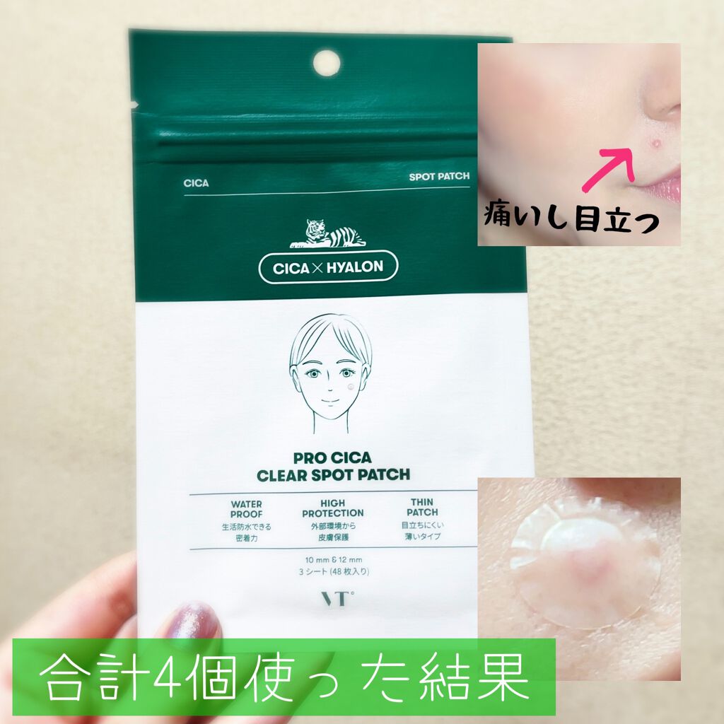ニキビ治療薬医薬品|メンソレータム アクネス他、1商品を使った口コミ Vtの ニキビパッチ 初使用でどうなったのか、今現在の状況