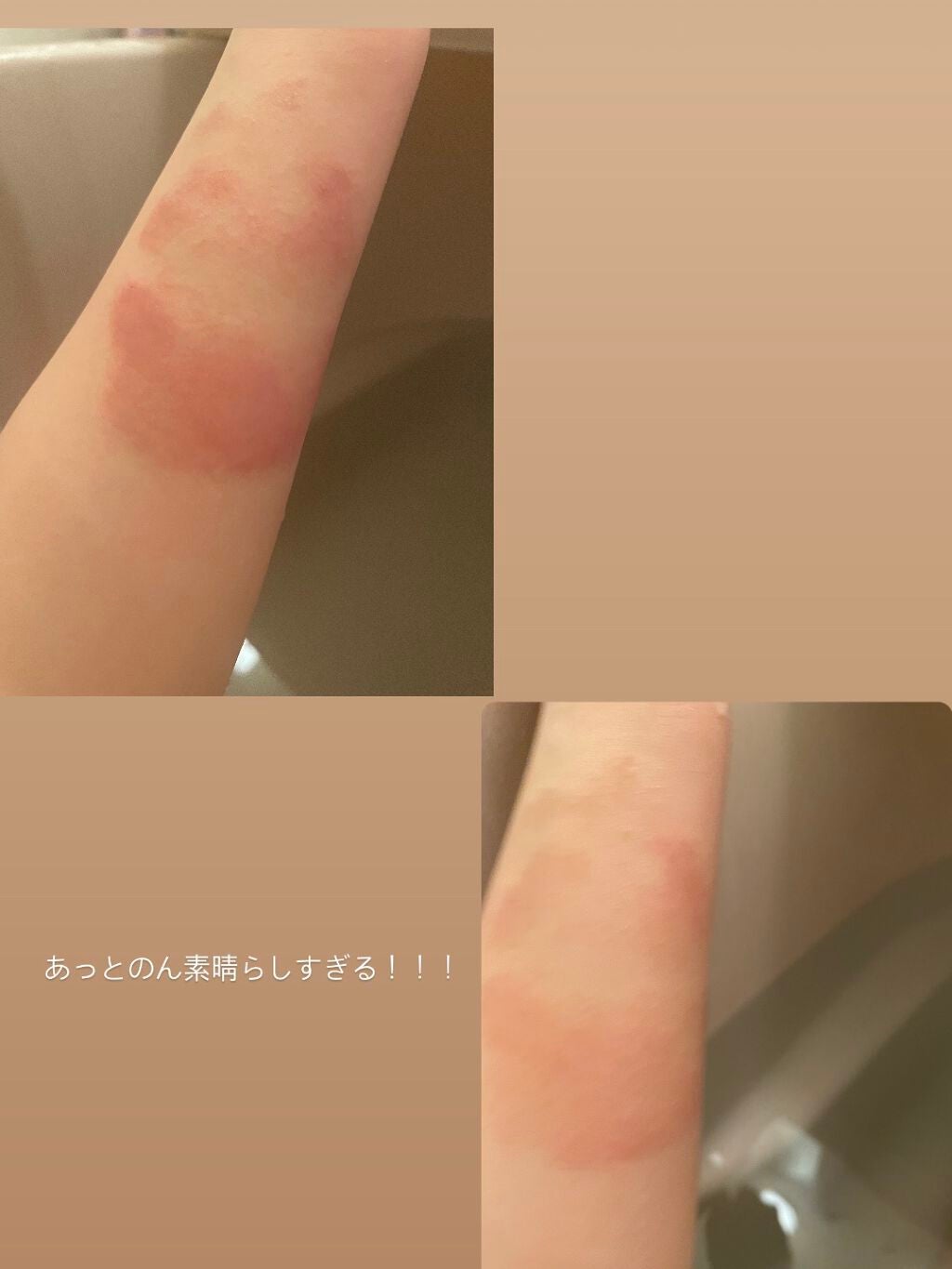 アットノンc Exクリーム医薬品|アットノンの効果に関する口コミ ⭐︎アットノン 医薬品⭐︎ 購入しました!! By のびのびヒトリ