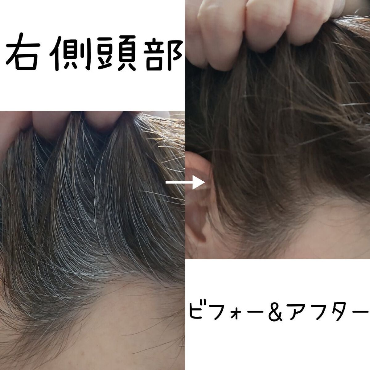 泡カラー 白髪用|ブローネの口コミ 昨日、毛染めしました。 ちょっと大事なお出掛け前にする By コンパス混合肌40代後半 Lips