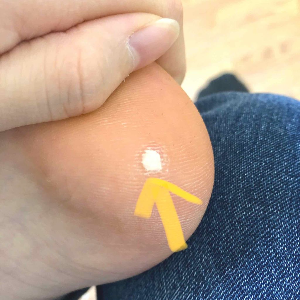 スピールジェル医薬品|ニチバンの口コミ イボや魚の目、タコに困っている方必見‼️ By Salt乾燥肌20代後半 Lips